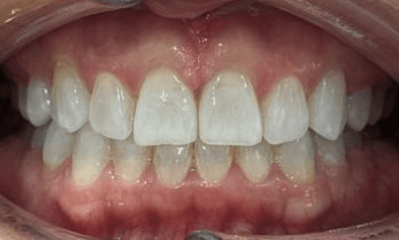 Invisalign® Before & After Photos | Newport VIC